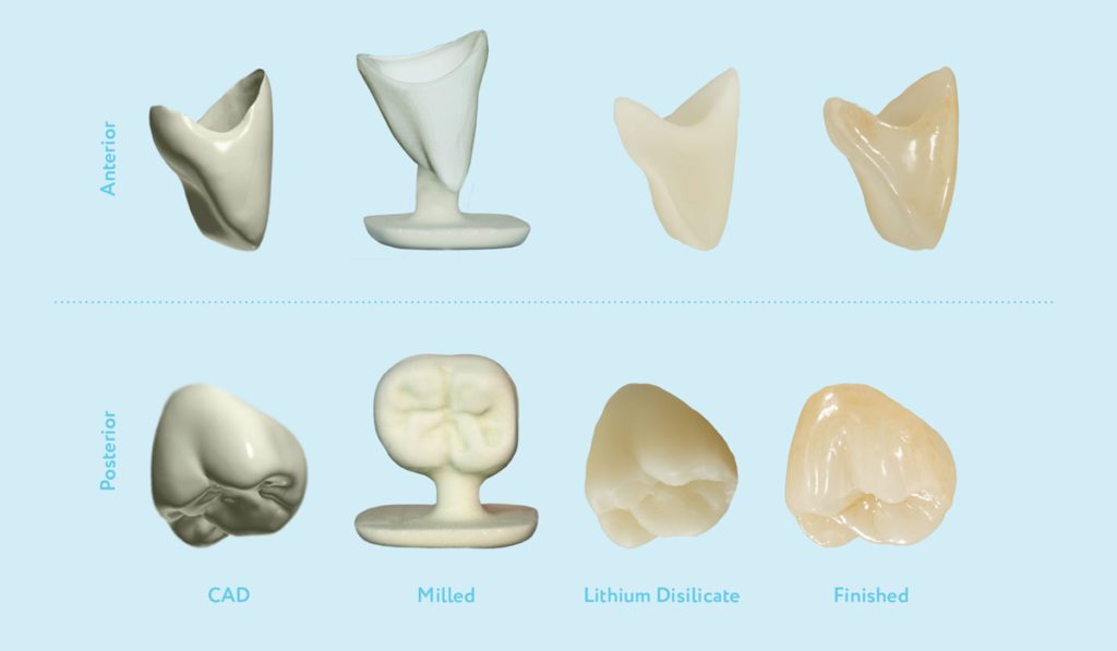 e.max® - Dental Crafters