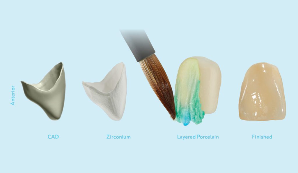 PFZ (Porcelain Fused Zirconia) - Dental Crafters