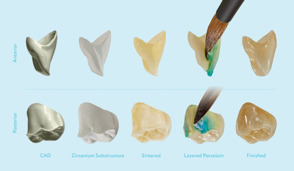 N.Dura™ Facial Cutback - Dental Crafters
