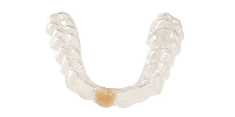 Essex Retainer - Dental Crafters