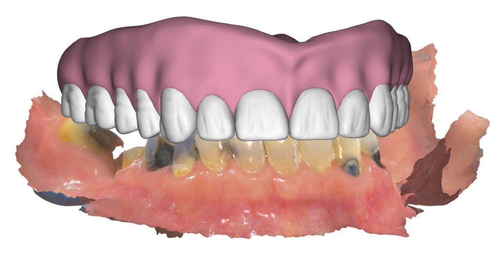 TrueDent™ Digital Temporary Denture - Dental Crafters
